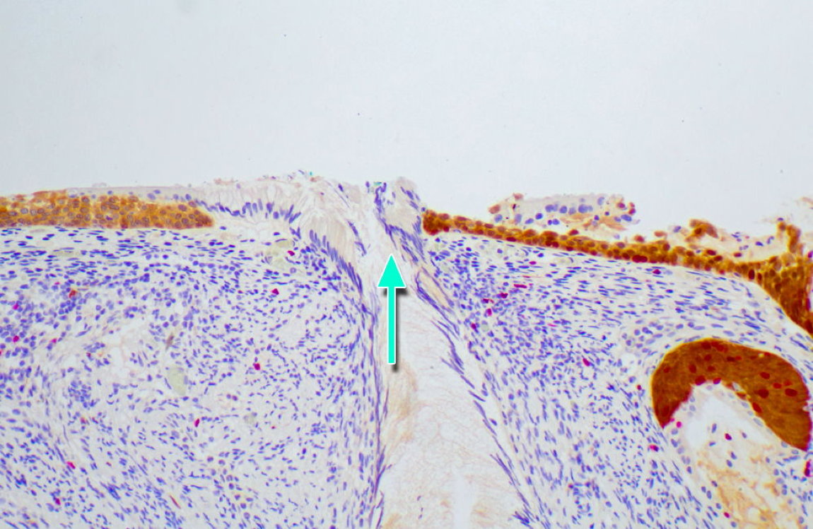 Secondary Prevention of Cervical Cancer