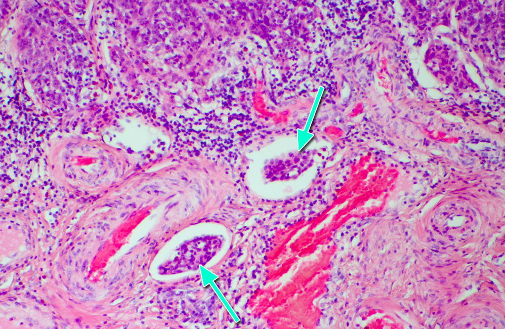 Secondary Prevention of Cervical Cancer