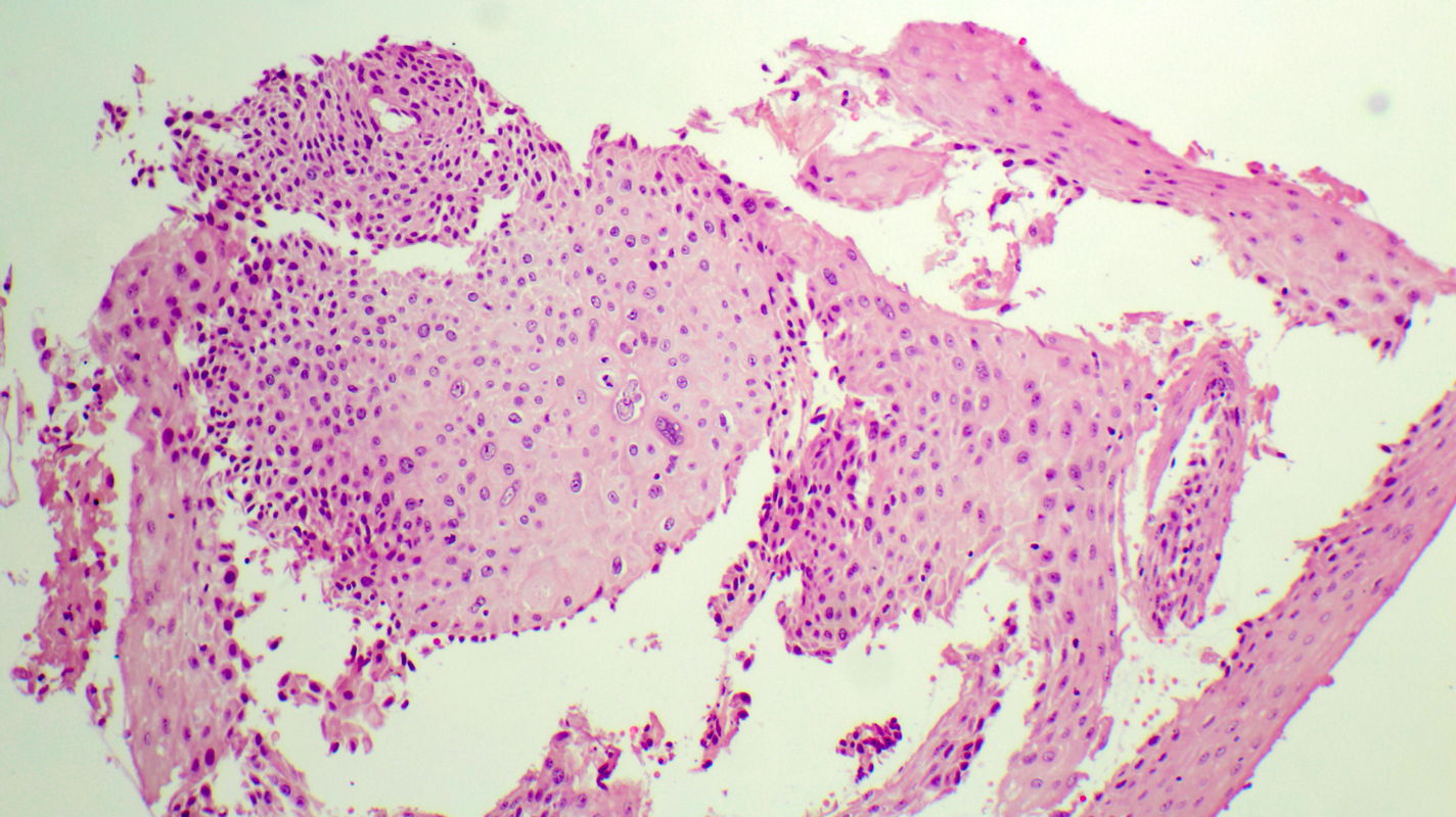 Secondary Prevention of Cervical Cancer