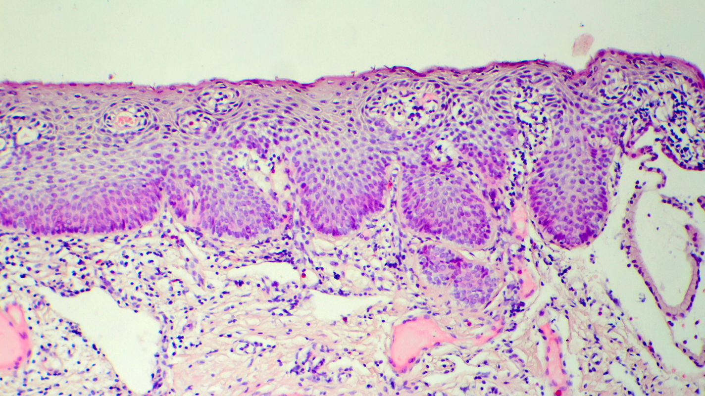 Secondary Prevention of Cervical Cancer