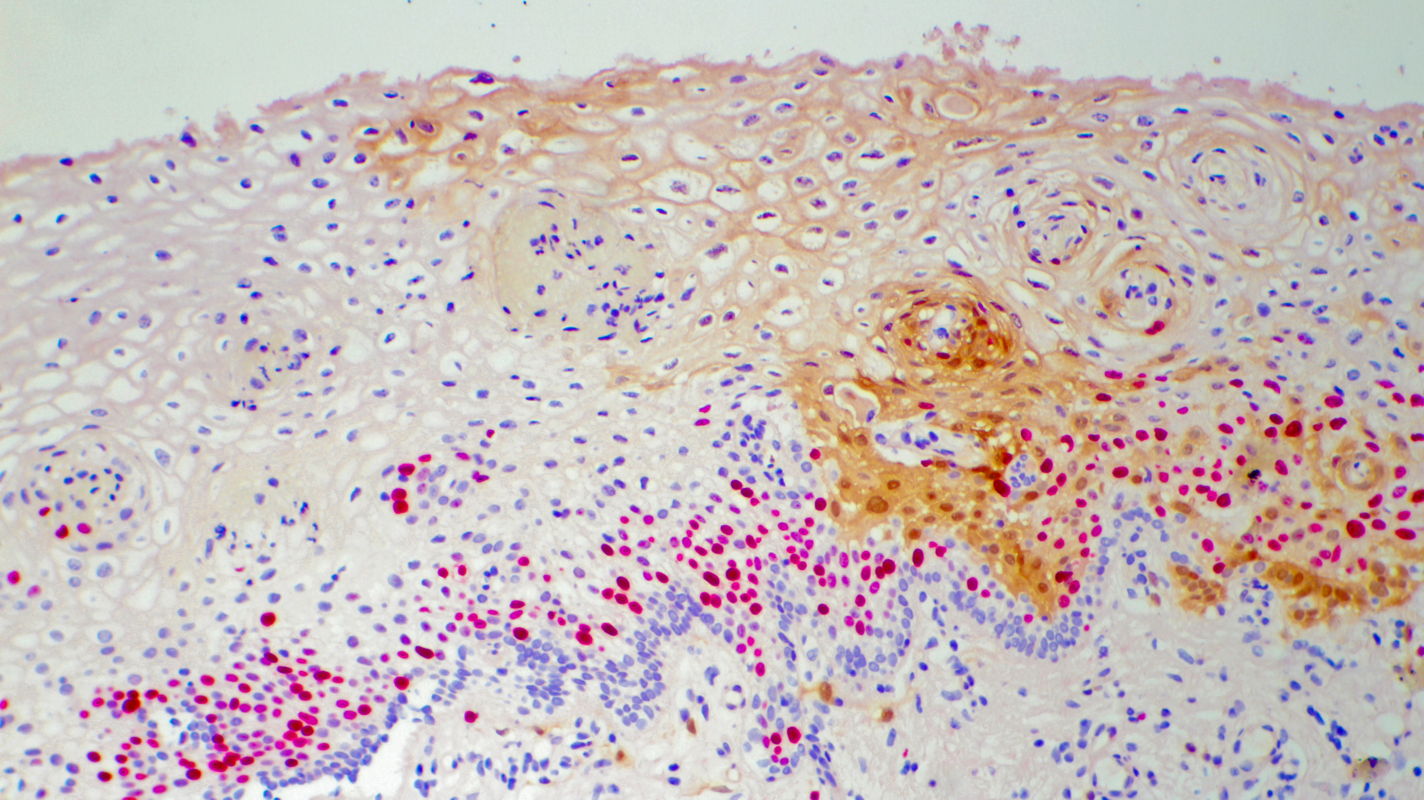 Secondary Prevention of Cervical Cancer