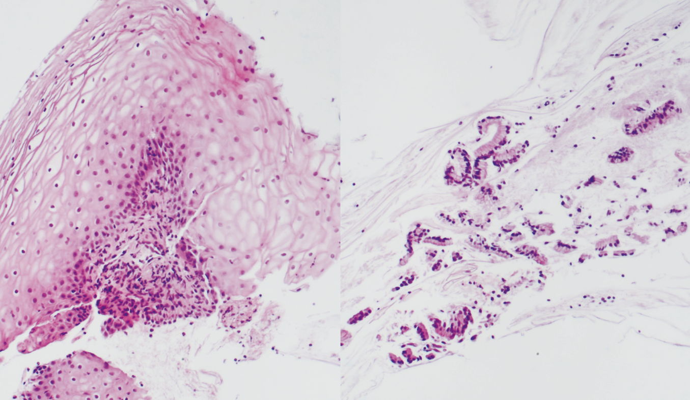 Secondary Prevention of Cervical Cancer