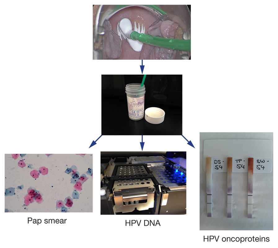 Secondary Prevention of Cervical Cancer
